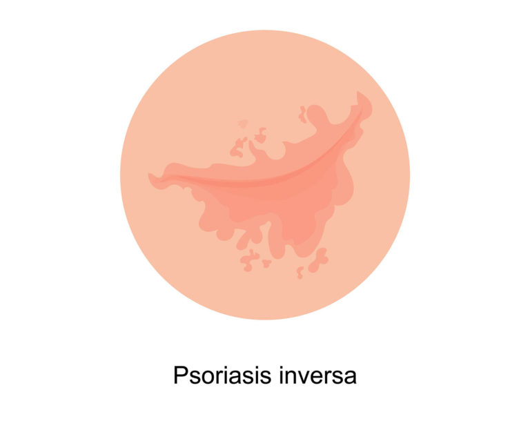 Axilas irritadas, causas y cómo evitarlo - Vida Activa