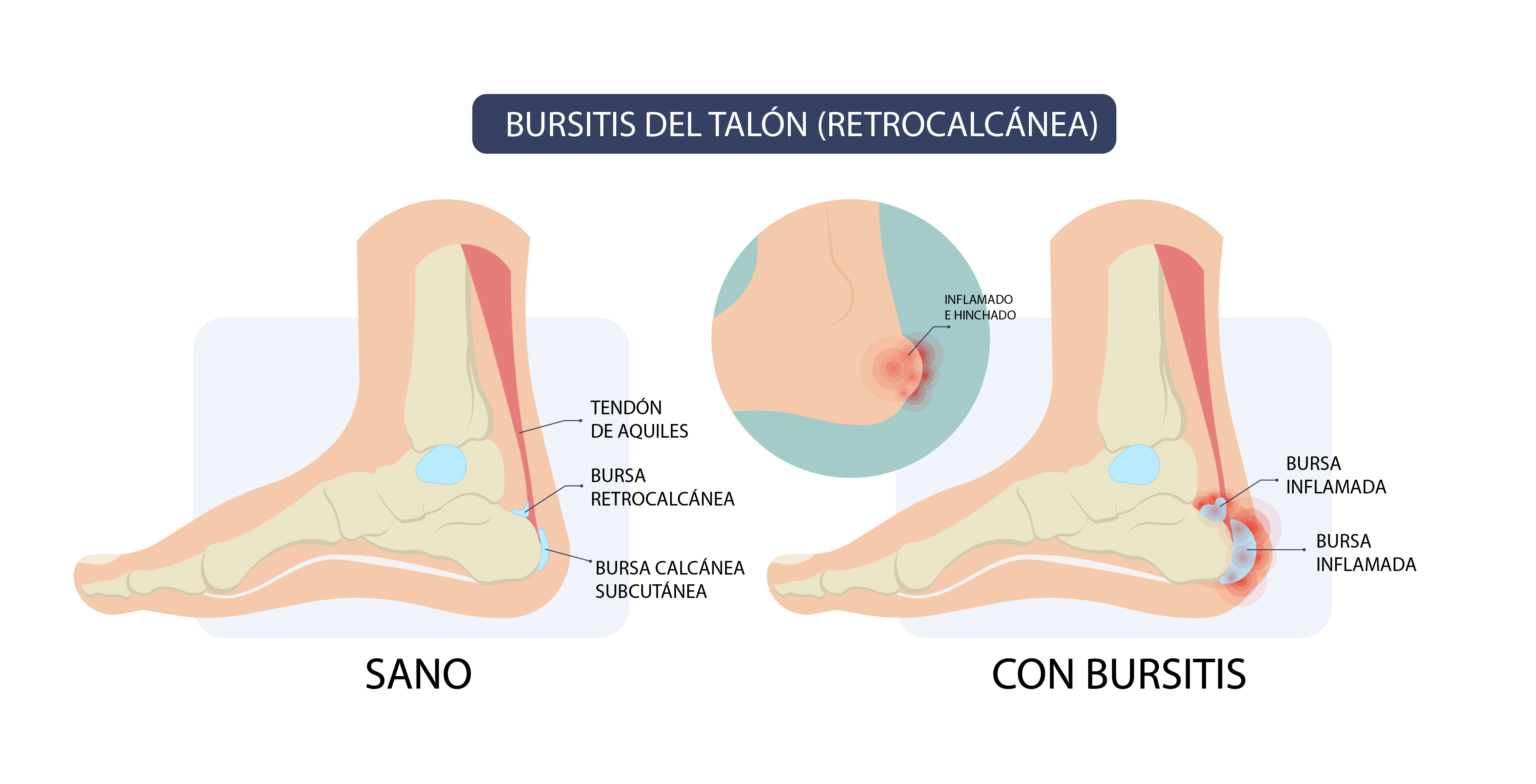 Dolor de tobillo ¿A qué se debe? - Vida Activa