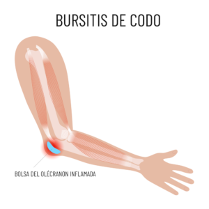 Bursitis de codo: qué es, causa, síntomas y tratamiento - PUVA
